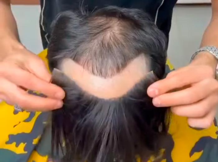 PRÓTESIS CAPILARES indetectables para hombres Hairs Premium